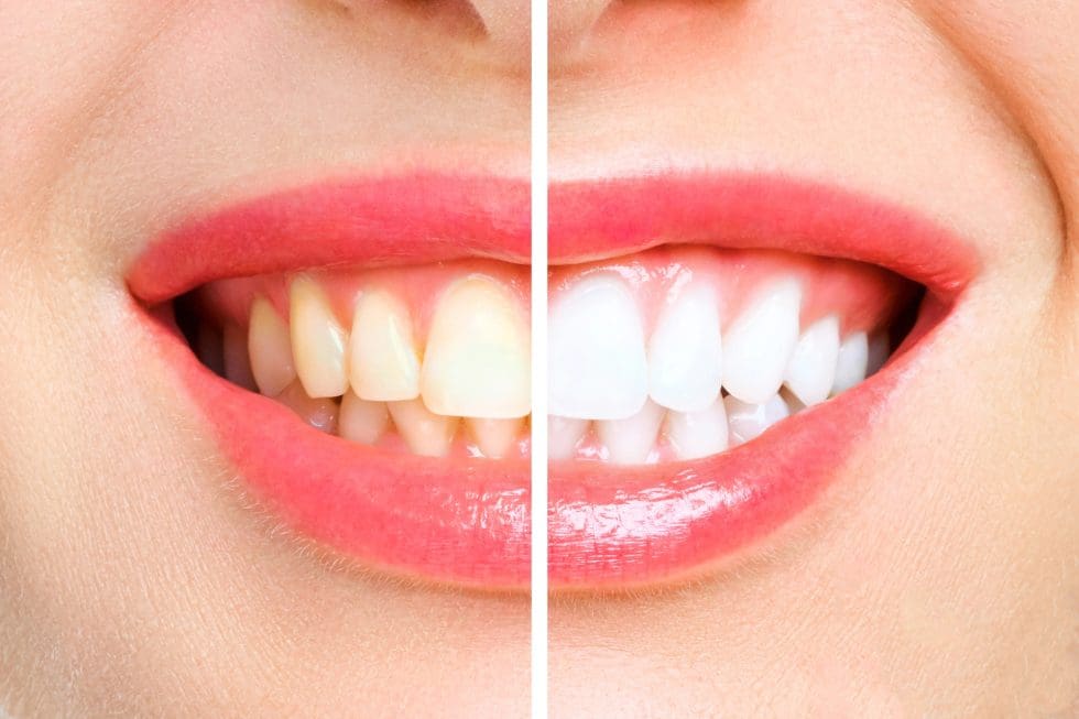 Laser Teeth Whitening vs Bleaching Differences: What’s Better?